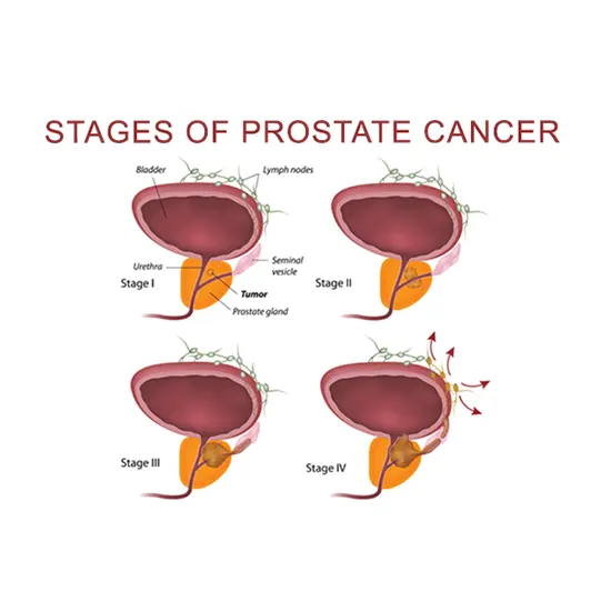 Prostate Cancer : Types, Stages, Symptoms, Causes, and Tests | Ganesh ...
