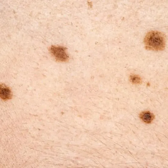 Skin Cancer : Types, Stages, Symptoms, Causes and Tests | Ganesh Diagnostic