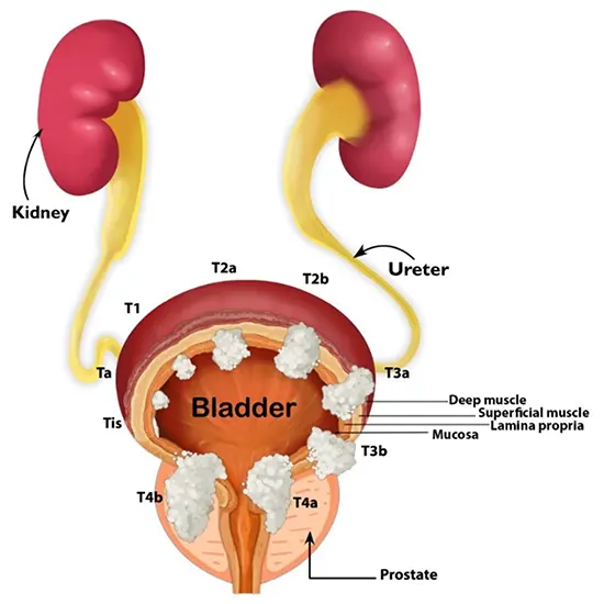 Urinary Bladder Cancer : Types, Stages, Symptoms, Causes and Tests ...