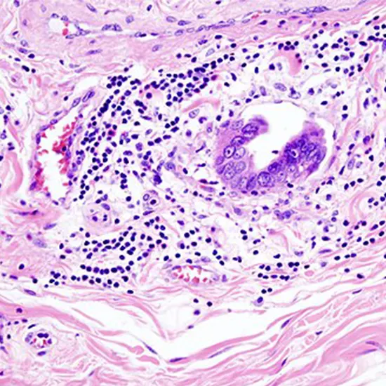 Gallbladder Cancer : Types, Stages, Symptoms, Causes and Tests | Ganesh ...