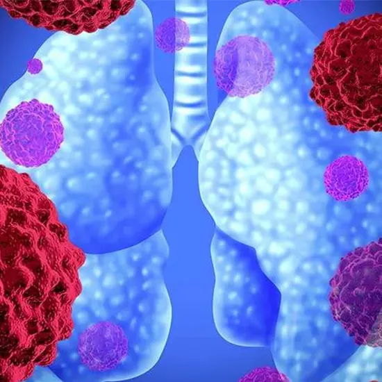 Lung Cancer : Types, Stages, Symptoms, Causes, and Tests | Ganesh ...
