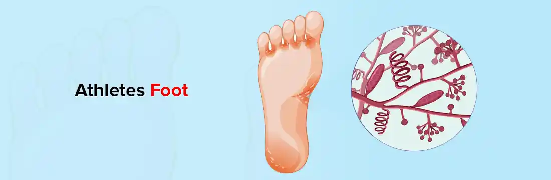 Fungal Infection: Types, Symptoms, Diagnosis And Treatment | Ganesh ...