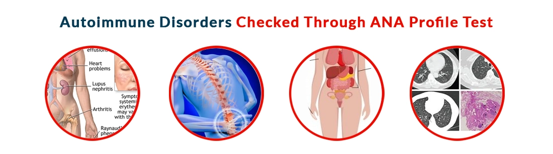 ANA Profile Test - Preparation, Procedure, Cost and Disease