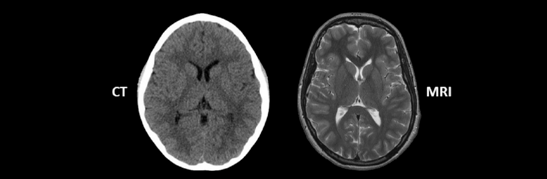 CT Brain Vs MRI Brain: Which Is Better Diagnostic Tool