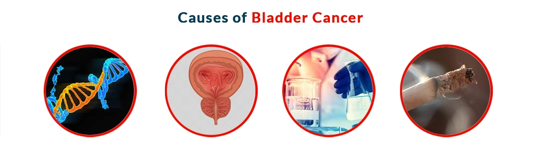 Bladder Cancer: Causes, Types, Diagnosis, Treatment, Prevention and Cost