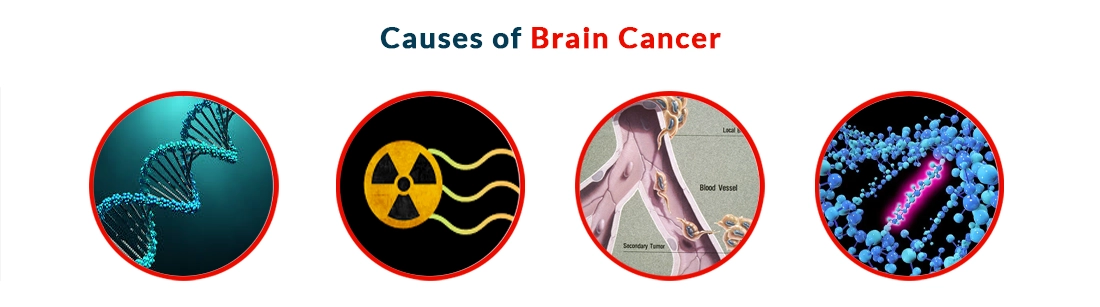 Brain Cancer: Causes, Types, Diagnosis, Treatment, Prevention and Cost