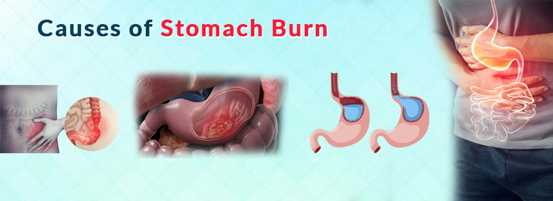 What Causes Your Stomach to Burn? Diagnosis and Remedies for Improvement