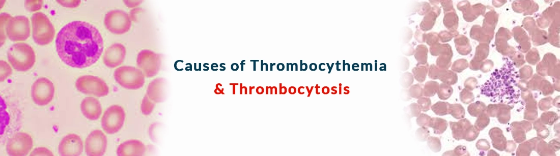 Thrombocythemia & Thrombocytosis: Symptoms, Causes, Diagnosis and Treatment