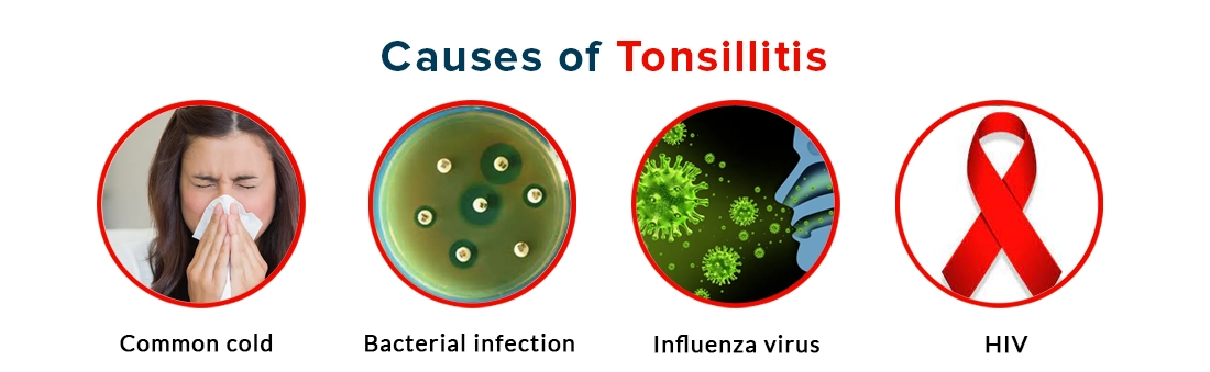 Is Tonsillitis Dangerous? Its Types, Causes,symptoms, Diagnosis And ...