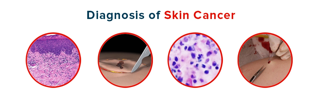 What is Skin Cancer? How It Represents | Ganesh Diagnostic