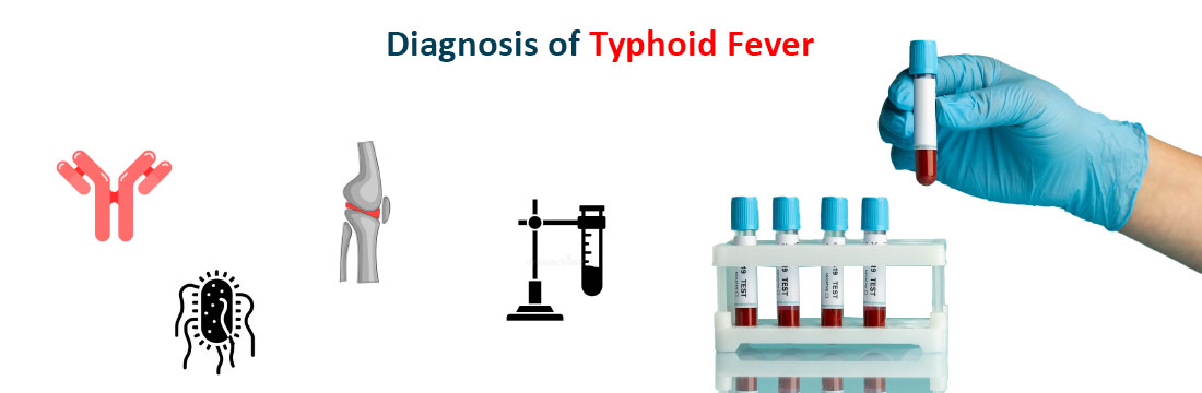 Blood Tests For Typhoid Fever: Symptoms, Causes and Treatment | Ganesh ...