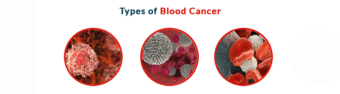 PET CT Scan as Diagnostic Tool for Blood Cancer, Types of Blood Cancer ...