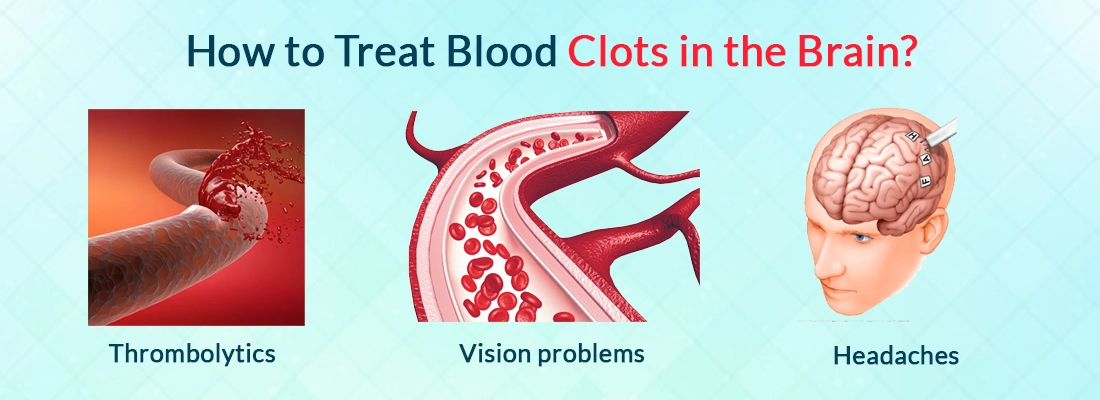 Blood Clot in Brain, Its Causes, Symptoms and Diagnosis | Ganesh Diagnostic