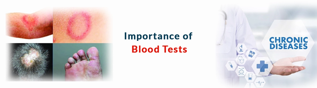 Blood Test at Home Its Types and Its Advantages | Ganesh Diagnostic