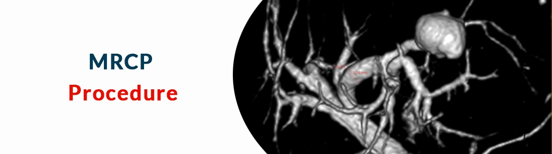 MRCP Test: What is It, Why is It Done, Results | Ganesh