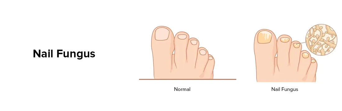 Fungal Infection: Types, Symptoms, Diagnosis And Treatment | Ganesh ...