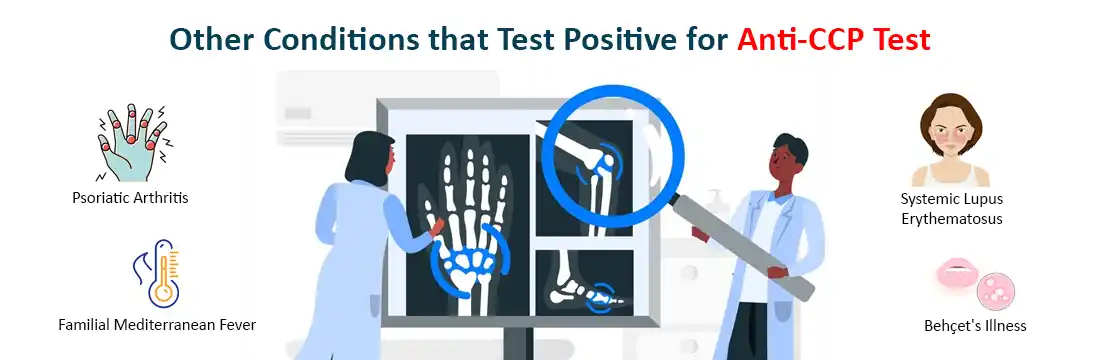 CCP Antibody Test : Know More About Your Arthritis | Ganesh Diagnostic