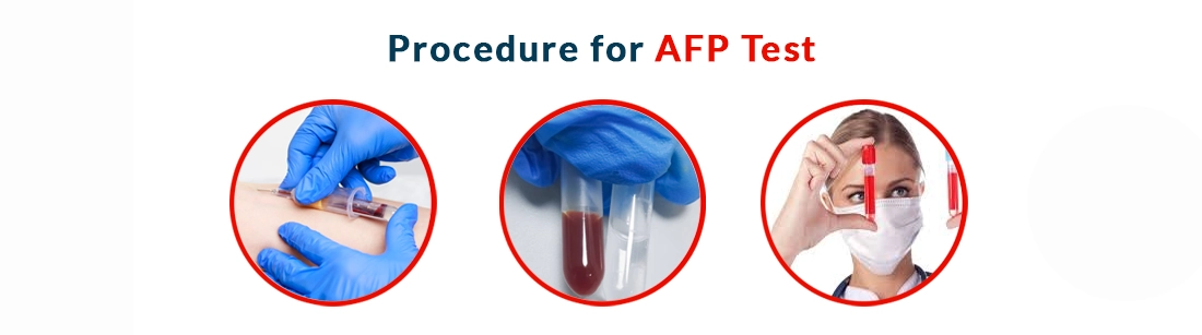 Alpha Fetoprotein Test With Its Role Uses And Significance