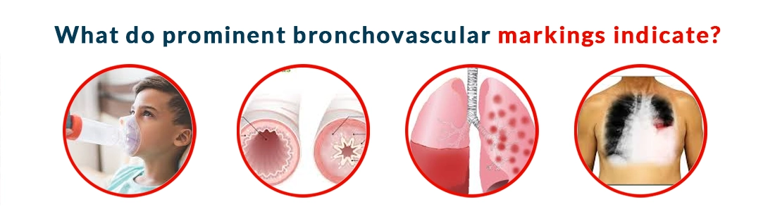 Prominent Bronchovascular Signs in Chest X-Ray Report | Ganesh Diagnostic
