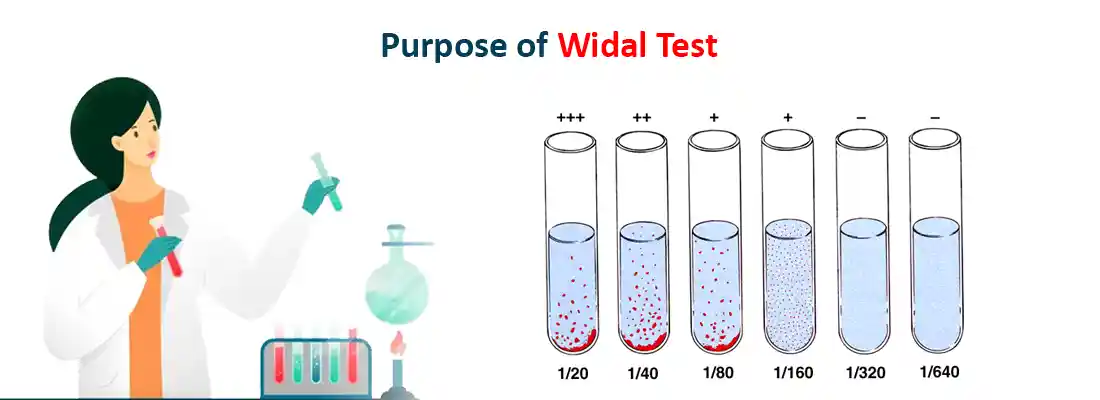 Widal Test for Typhoid Fever: Purpose, Preparation, Procedure and Results