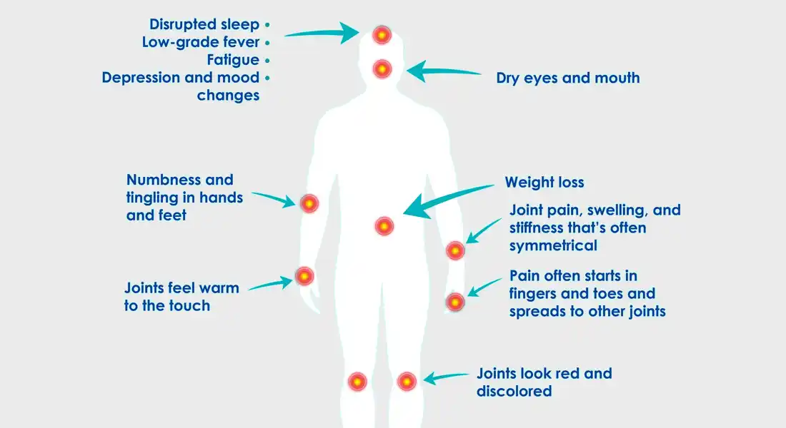 Living with Rheumatoid Arthritis: Cause, Types and Prevention
