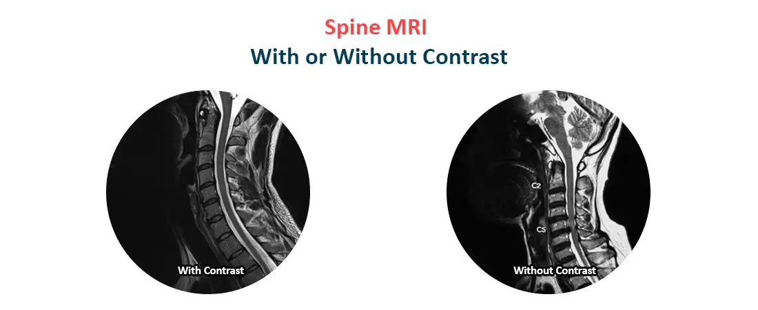 Decoding Spinal Cord MRI: A Patient Guide | Ganesh Diagnostic