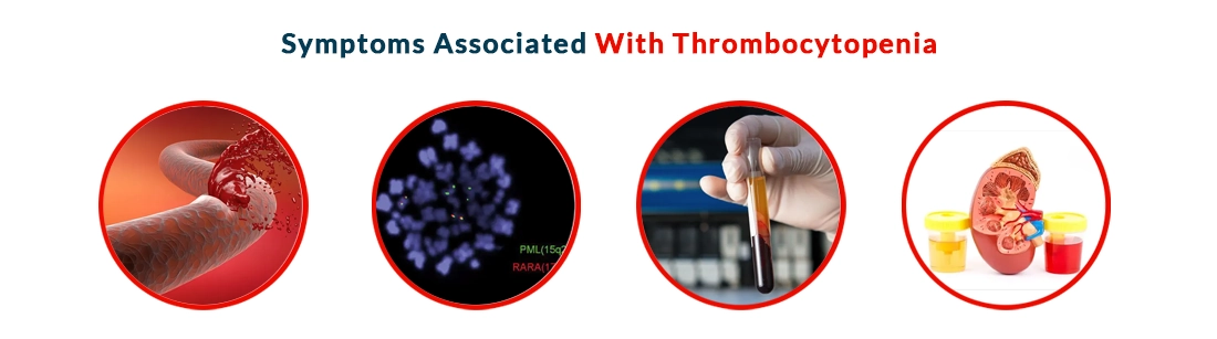 Thrombocytopenia: Causes, Symptoms, Diagnosis and Treatment