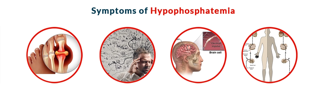 Hypophosphatemia: Causes, Symptoms, Diagnosis and Treatment