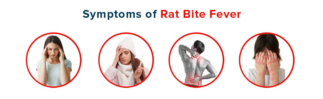 Rat-Bite Fever (RBF): Causes, Symptoms, Treatment and Complications