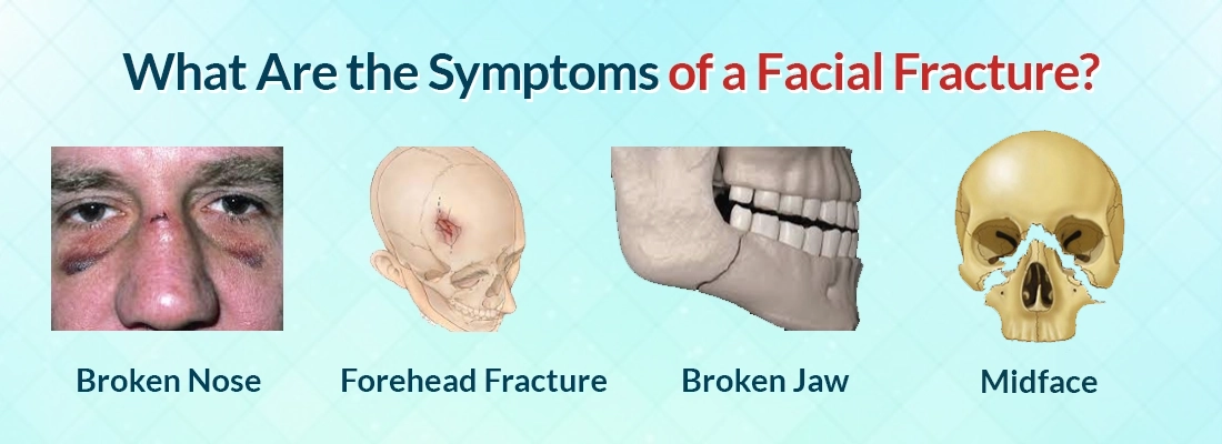 Facial Fractures and Its Diagnosis, OPG, CT and Other X Rays