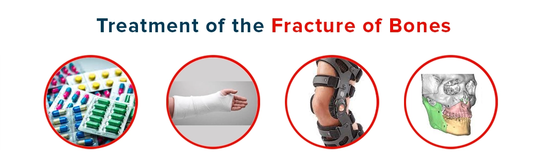 What is Bone Fracture : Its Symptoms, Causes, Types, Diagnosis And ...