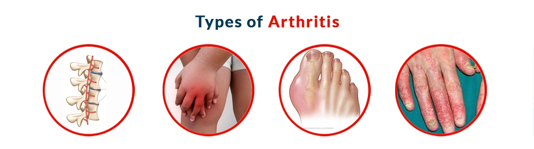What Is Arthritis? Know Its Causes, Symptoms and Diagnosis