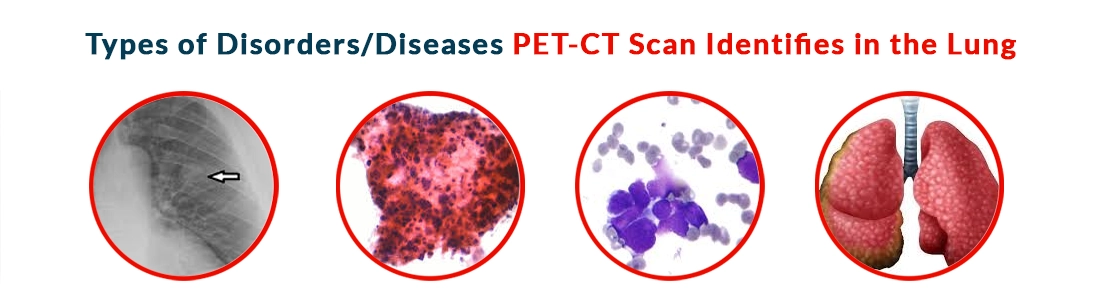 PET-CT Scan as Diagnostic Tool for Lung Disorders, PET-CT Scan Centres ...