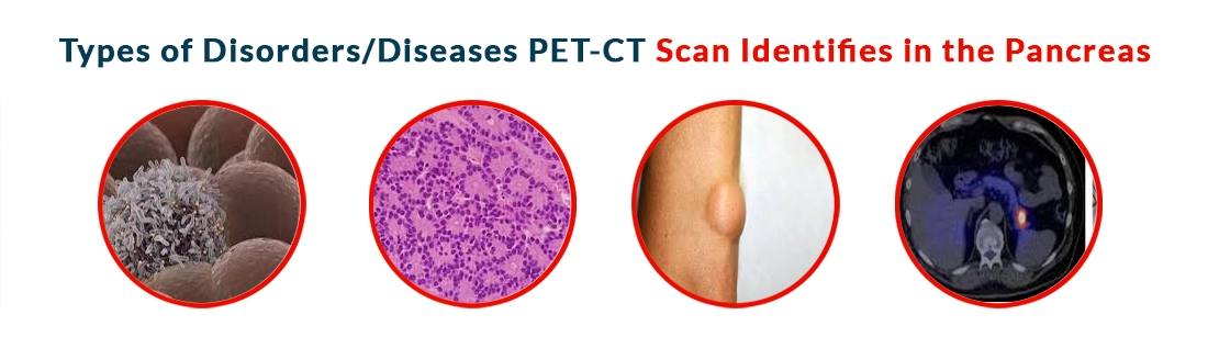 PET CT Scan as Diagnostic Tool for Pancreatic Disorders, Centres and Cost