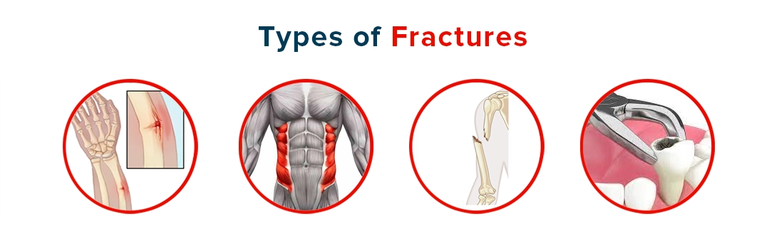 What is Bone Fracture : Its Symptoms, Causes, Types, Diagnosis And ...