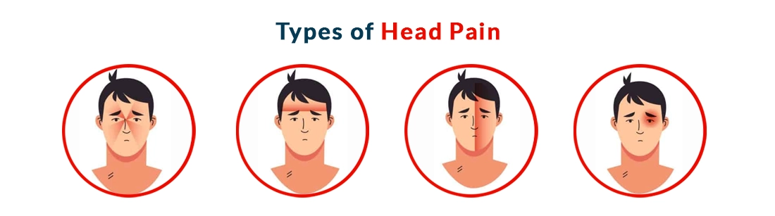Types of Head Pain: Causes, Symptoms & Treatment