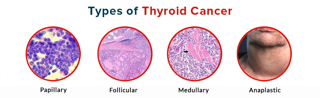 Need to Know About PET CT Scan in Diagnosing the Thyroid Cancer