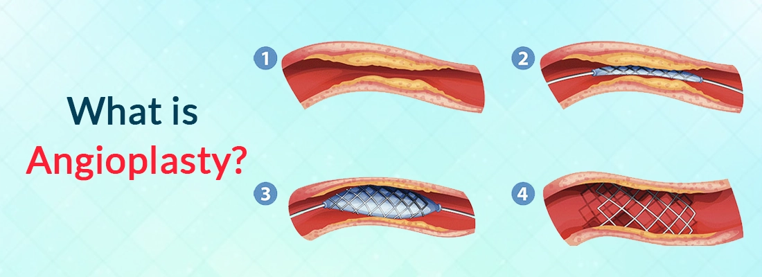 What is the Difference Between Angioplasty and Angiography