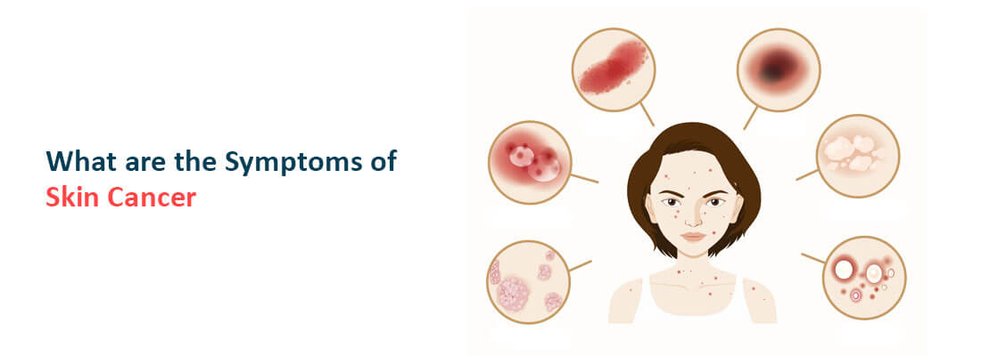 Delve Into Skin Cancer: Its Biopsy, Blood Tests and Molecular Testing ...