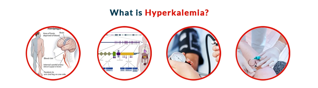 Hyperkalemia: Causes, Symptoms, Diagnosis, Management and Treatment