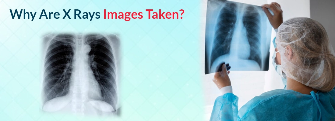 Scared of Getting TB Tested? Get It Checked by X Rays Painless and Quick
