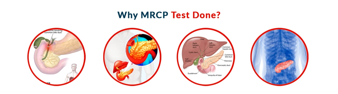 MRCP Test: What is It, Why is It Done, Results | Ganesh