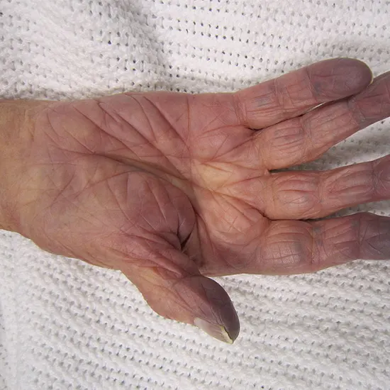 Hypoxia and Cyanosis: Overview, Causes, Symptoms & Treatment