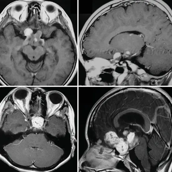 Hypothalamic Glioma - Symptoms, Types, Causes & Diagnosis
