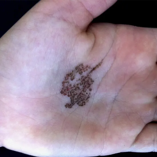 Beat The Dark Invaders : Know The Signs And Treatments For Tinea Nigra ...