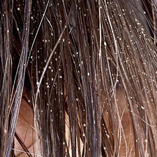 The Outbreak Of White Piedra Fungal Infection Linked To Hair Salons ...