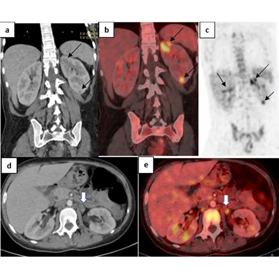 How PET Scan Diagnose The Fever Of Unknown Origin? | Ganesh Diagnostic
