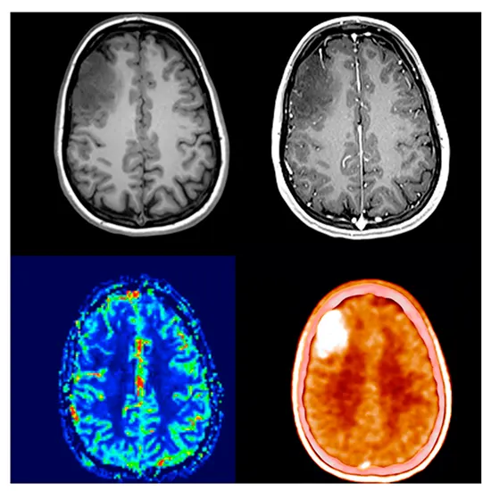 What Are The Indications For Brain PET Scan? | Ganesh Diagnostic