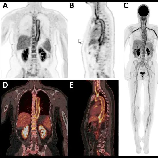 How Does PET Scan Work In Pyrexia Of Unknown Origin? | Ganesh Diagnostic