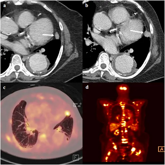 What Is The Role Of CT Scan In The Staging Of Cancer? | Ganesh Diagnostic